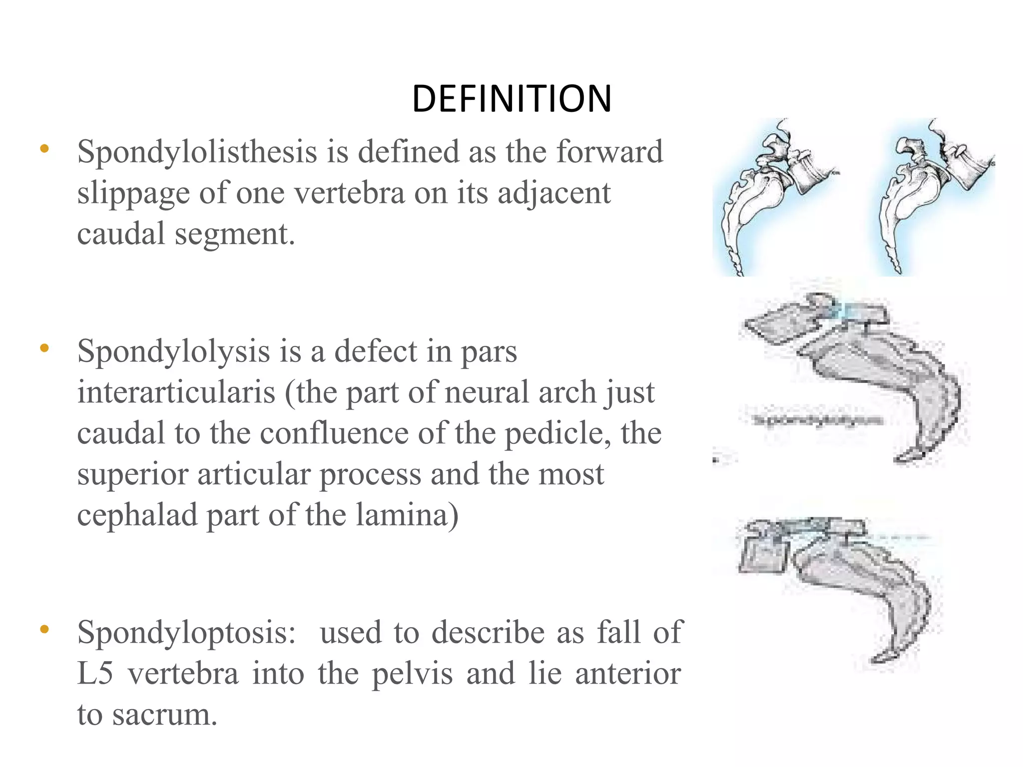 Spondylolisthesis | PPT