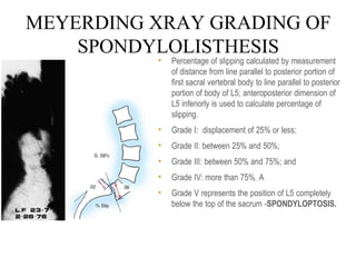 Spondylolisthesis | PPT