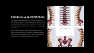 Spondylolisthesis (we are spine).pptx