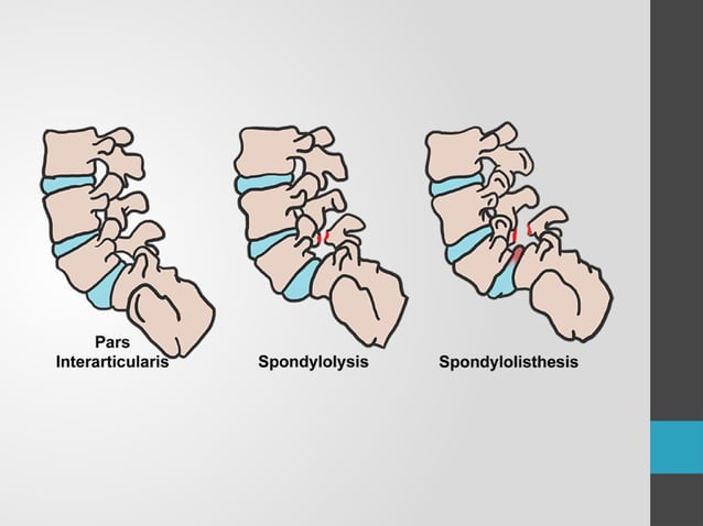 Spondylolithesis.pptxxxxxxxxxxxxxxxxxxxxxxxxxxxxxxx | PPT
