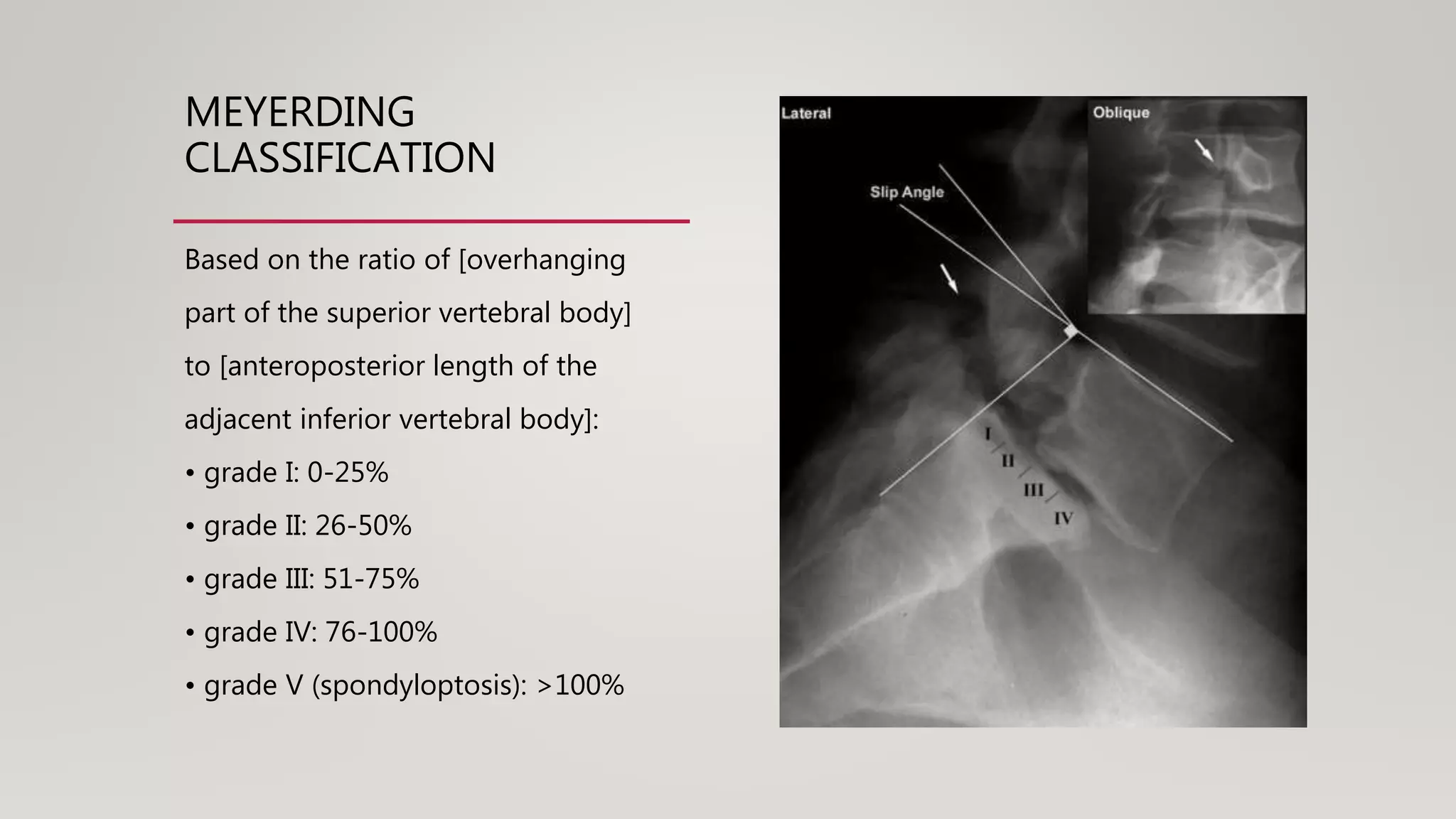 Spondylolithesis (1) | PPTX