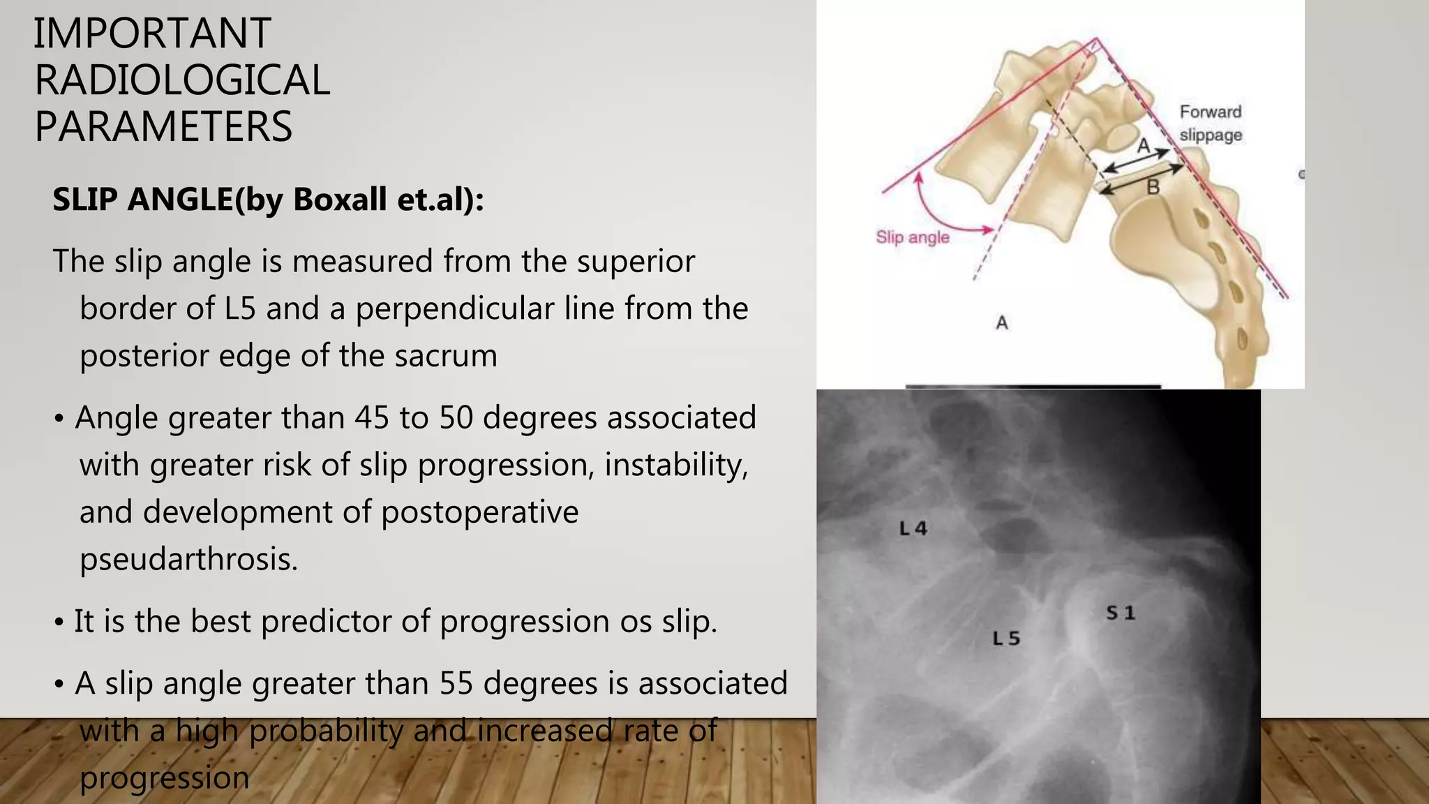 Spondylolithesis (1) | PPTX