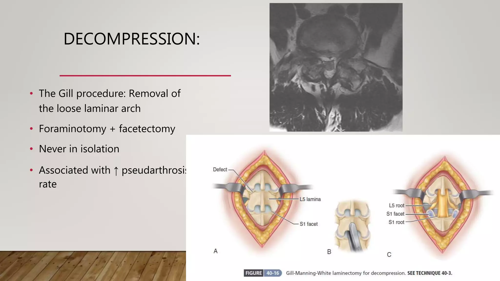 Spondylolithesis (1) | PPTX