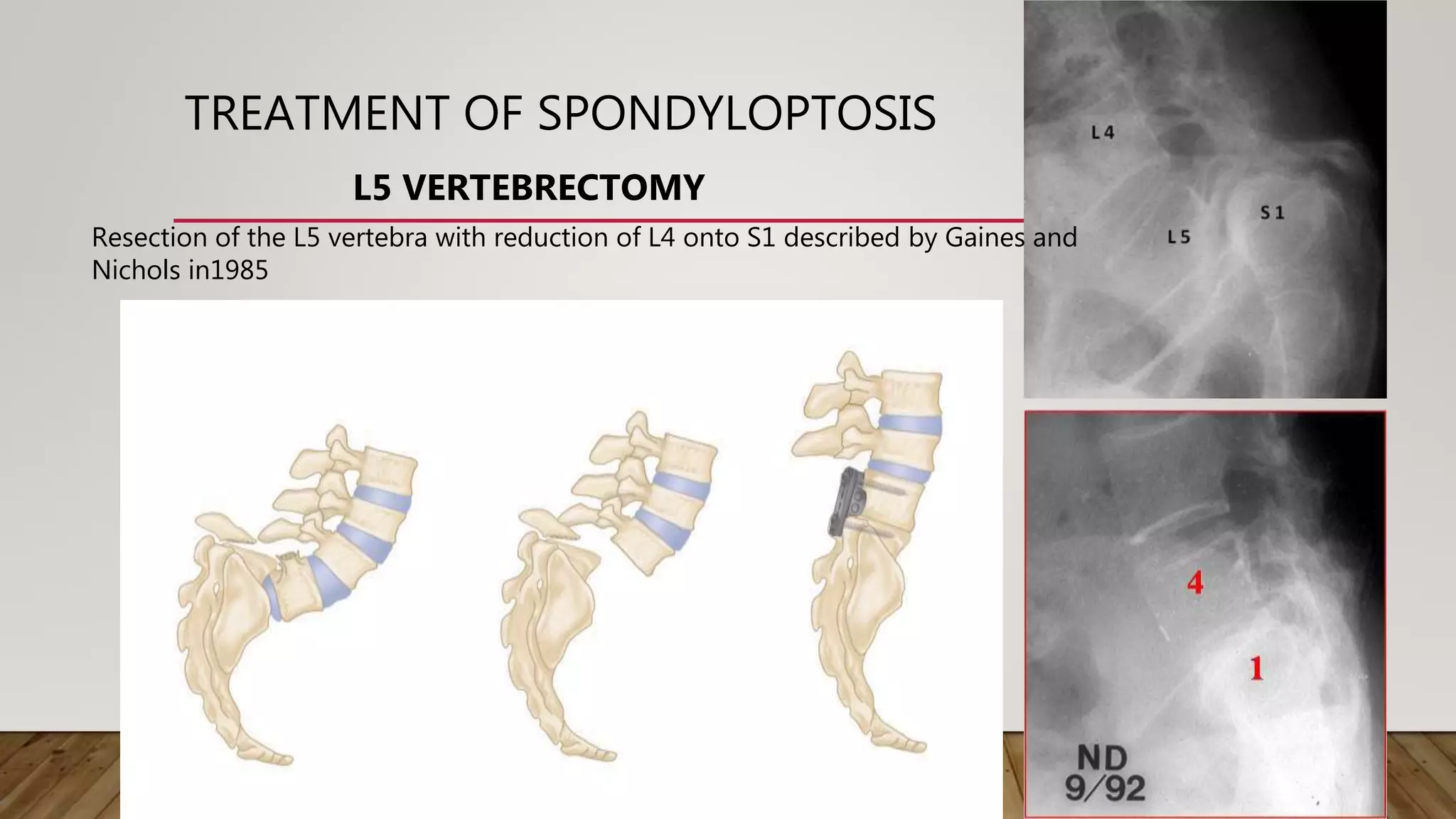 Spondylolithesis (1) | PPTX