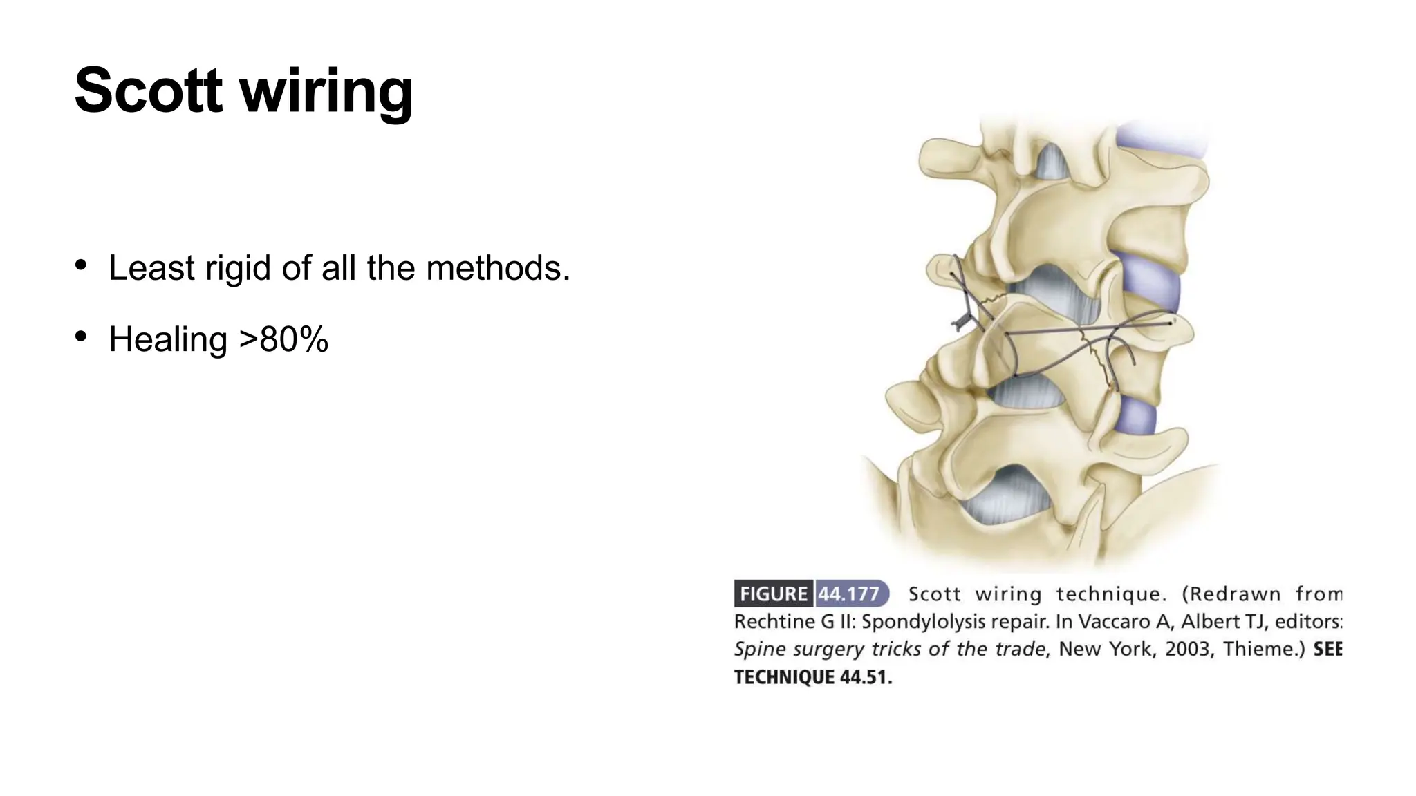 Spondylolysis.pptx by Dr Adarsha HM, Orthopaedic Spine Surgeon | PPTX