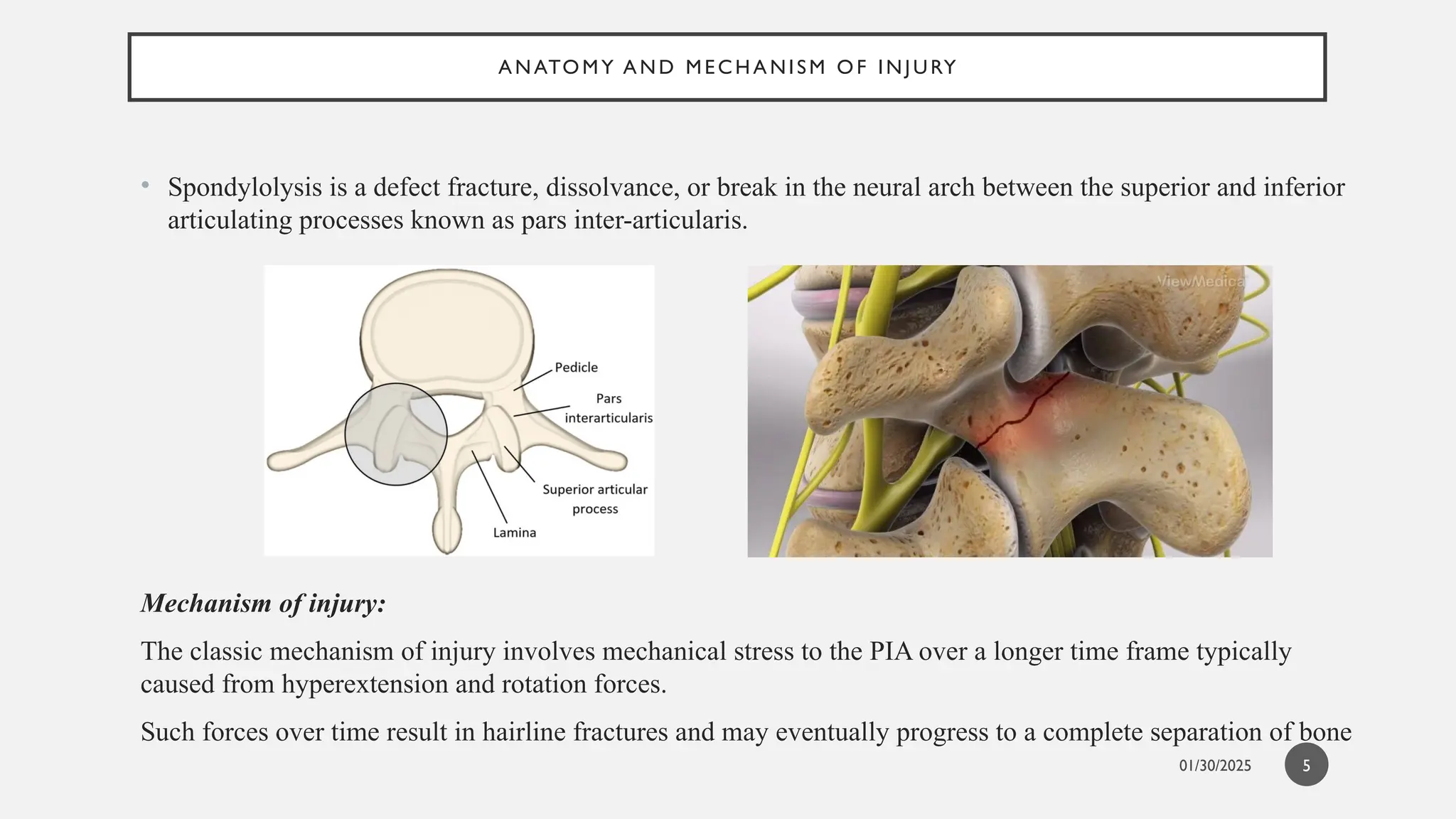 SPONDYLOLYSIS- SPINAL ORTHOTIC MANAGEMENT | PPTX
