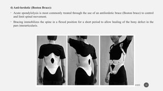 SPONDYLOLYSIS- SPINAL ORTHOTIC MANAGEMENT | PPTX