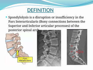 SPONDYLOLYSIS AND SPONDYLOLISTHESIS .pptx