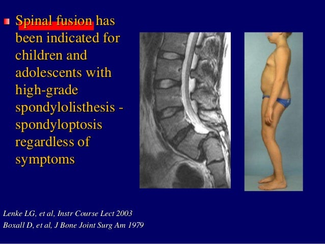Spondyloptosis