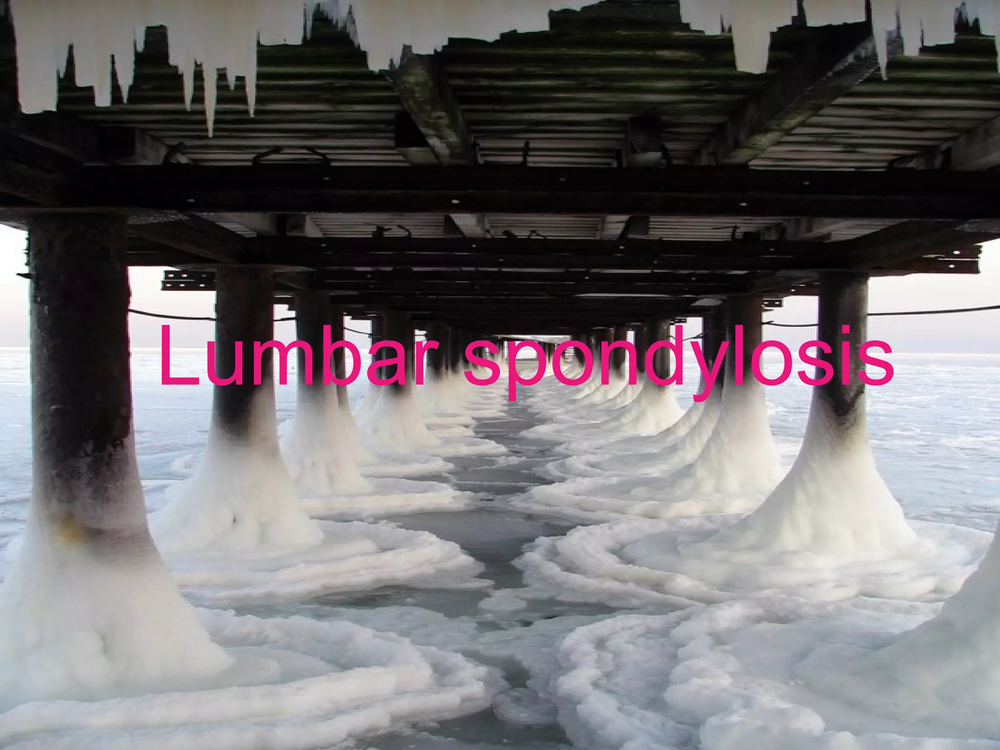 Spondylosis | PPT