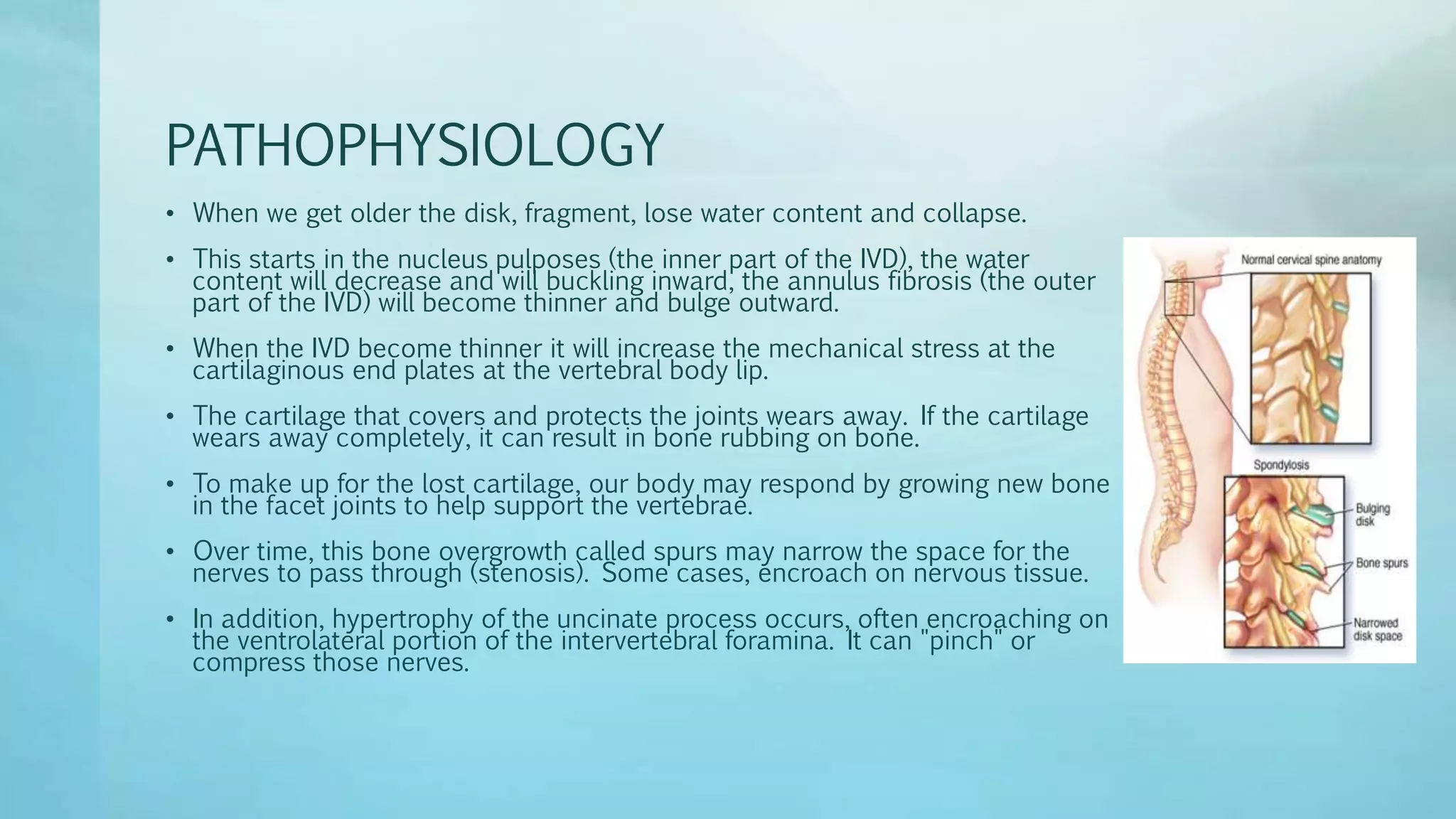 Spondylosis | PPTX