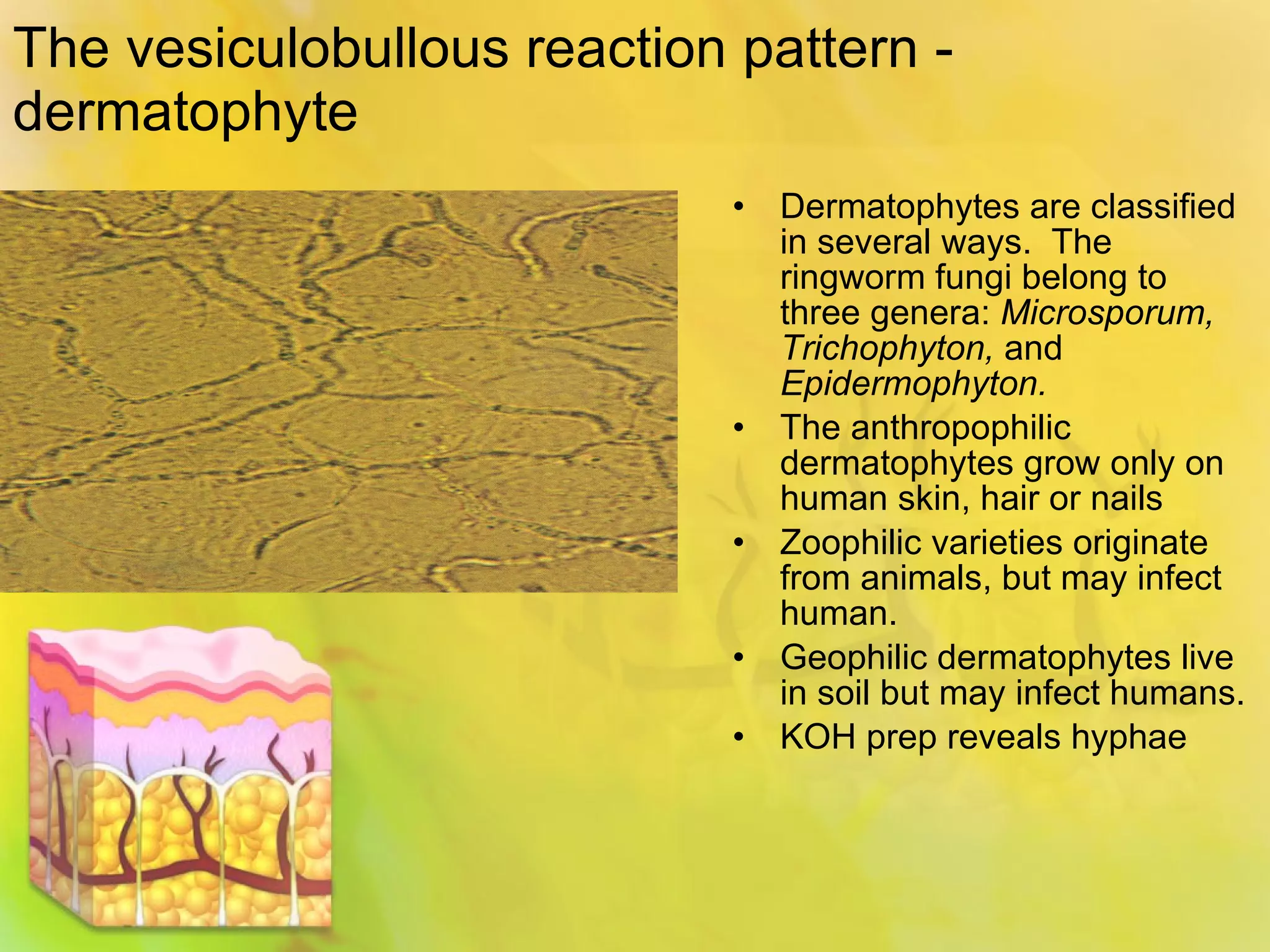 Spongiotic dermatitis tinea | PPT