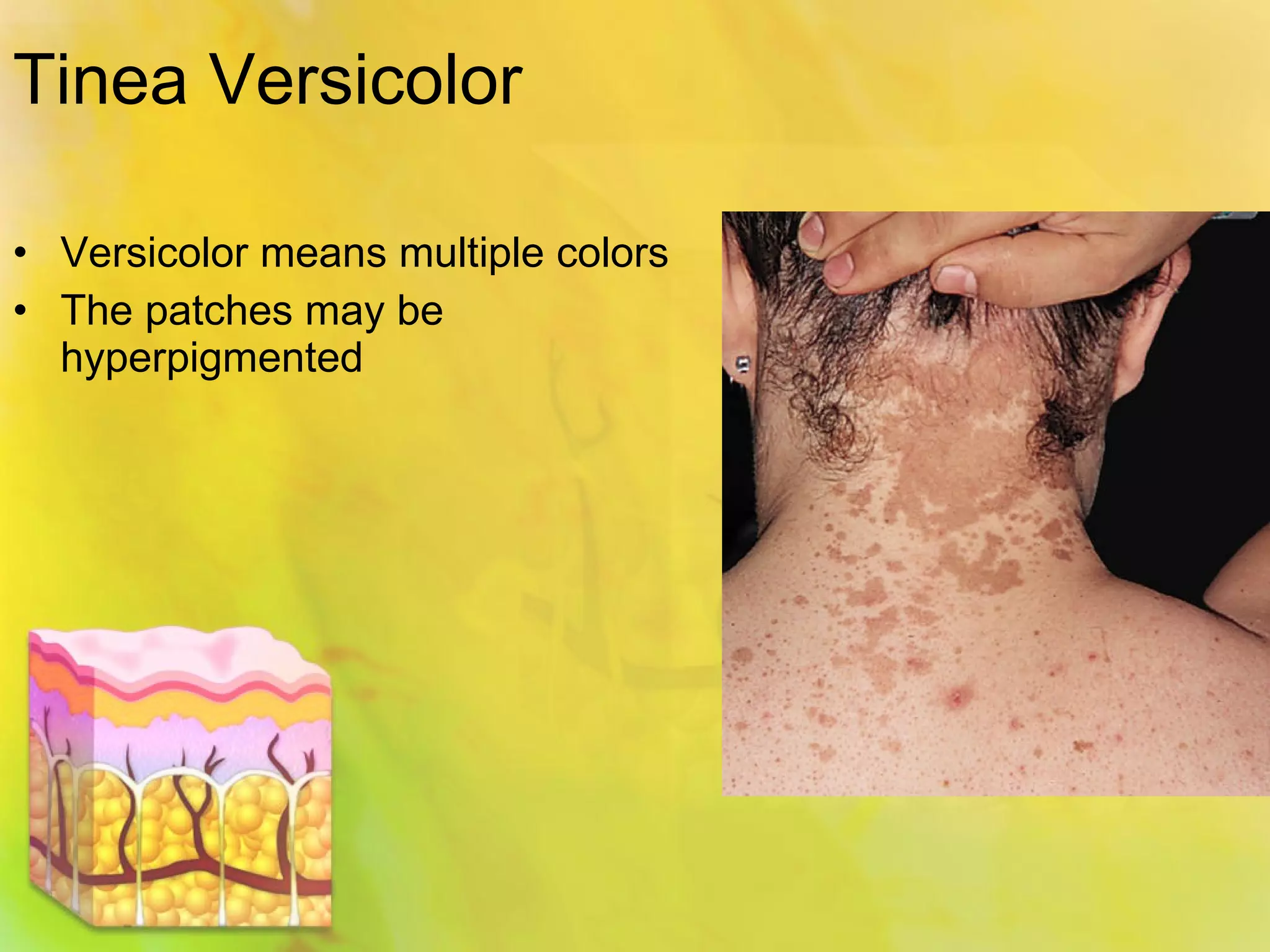 Spongiotic dermatitis tinea | PPT