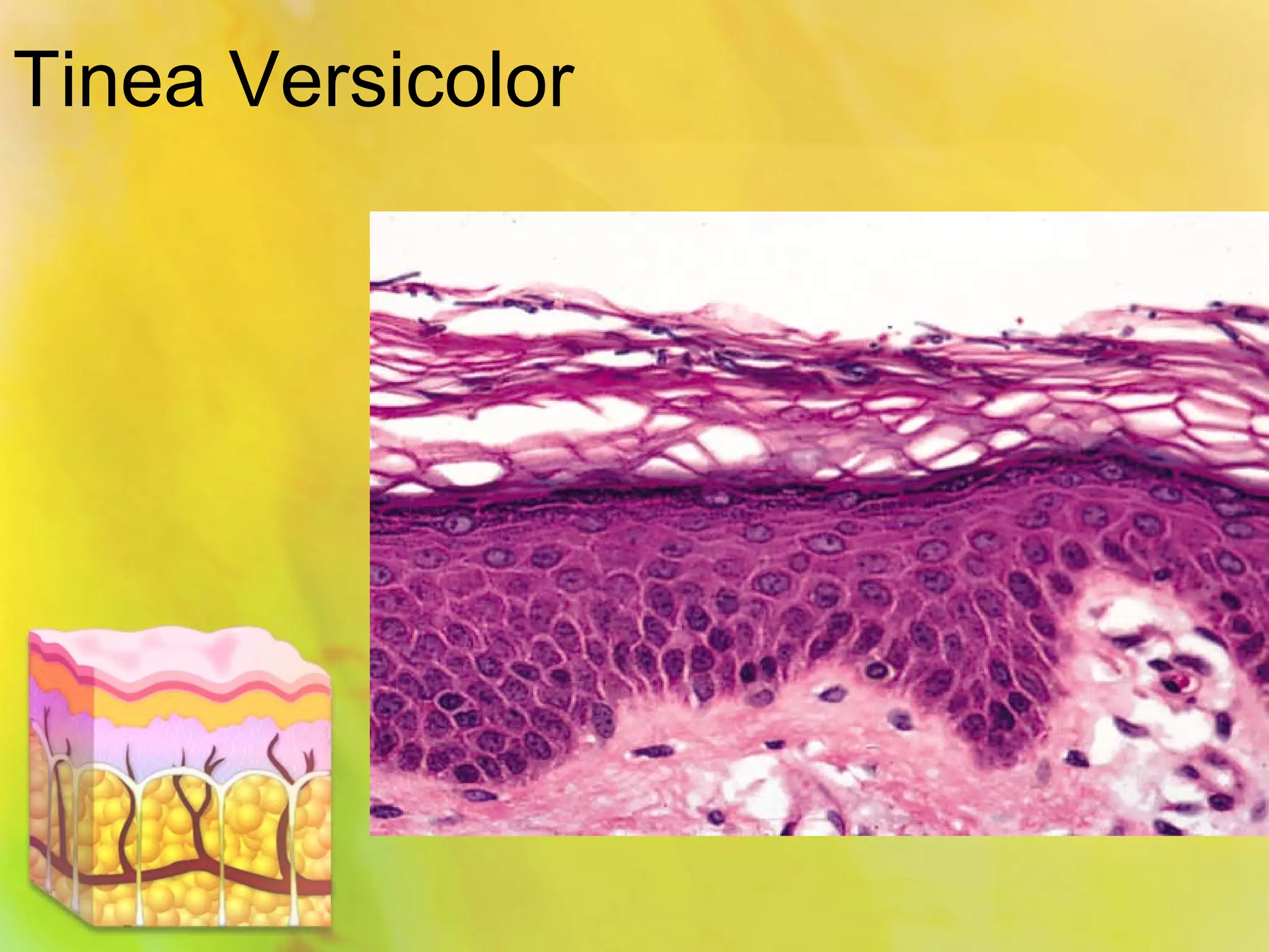 Spongiotic dermatitis tinea | PPT