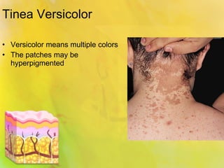 Spongiotic dermatitis tinea | PPT
