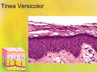 Spongiotic dermatitis tinea | PPT
