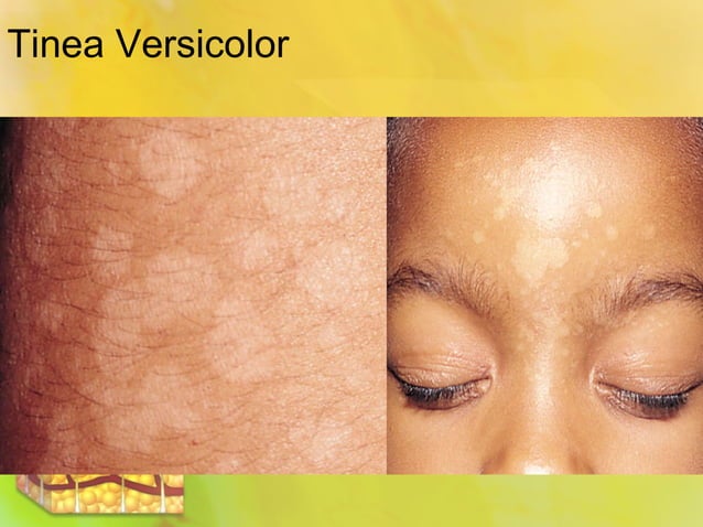 Spongiotic dermatitis tinea | PPT