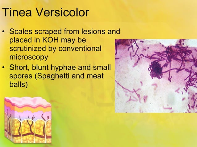 Spongiotic dermatitis tinea | PPT