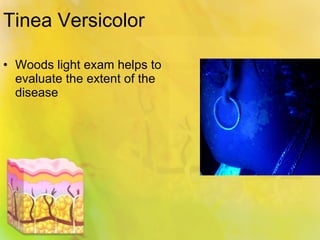 Spongiotic dermatitis tinea | PPT