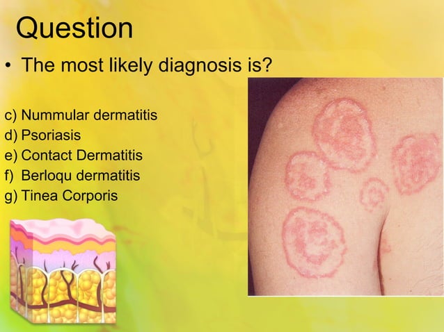 Spongiotic dermatitis tinea | PPT