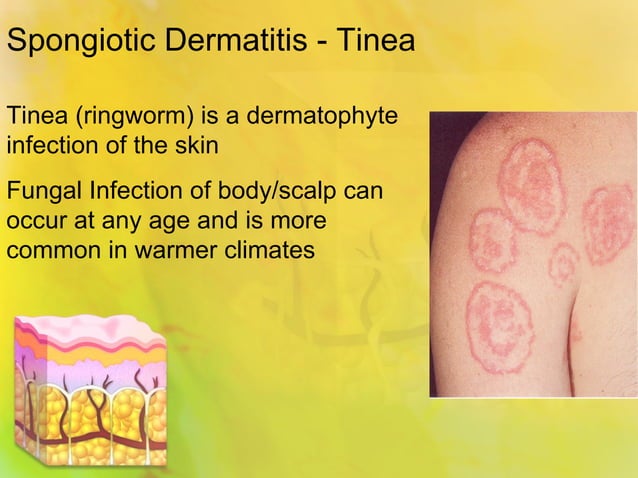 Spongiotic dermatitis tinea | PPT