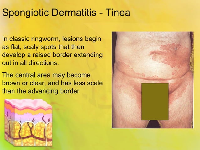 Spongiotic dermatitis tinea | PPT