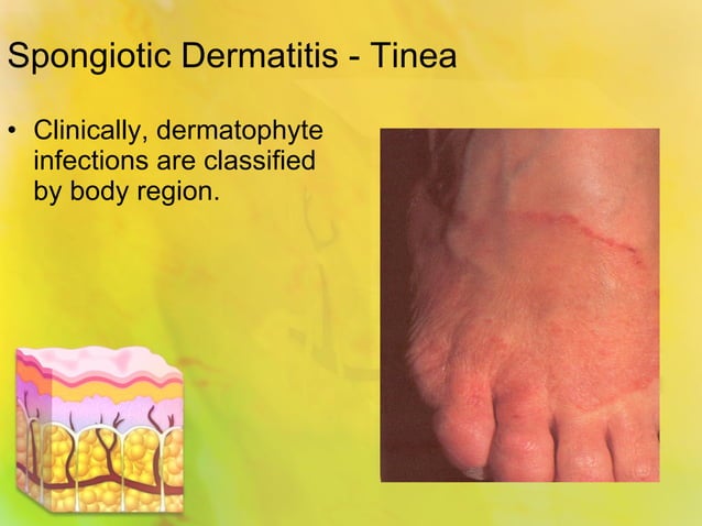 Spongiotic dermatitis tinea | PPT
