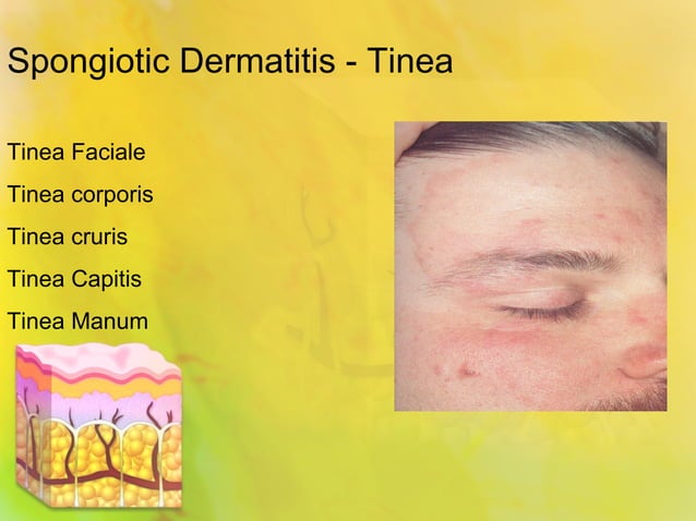 Spongiotic dermatitis tinea | PPT