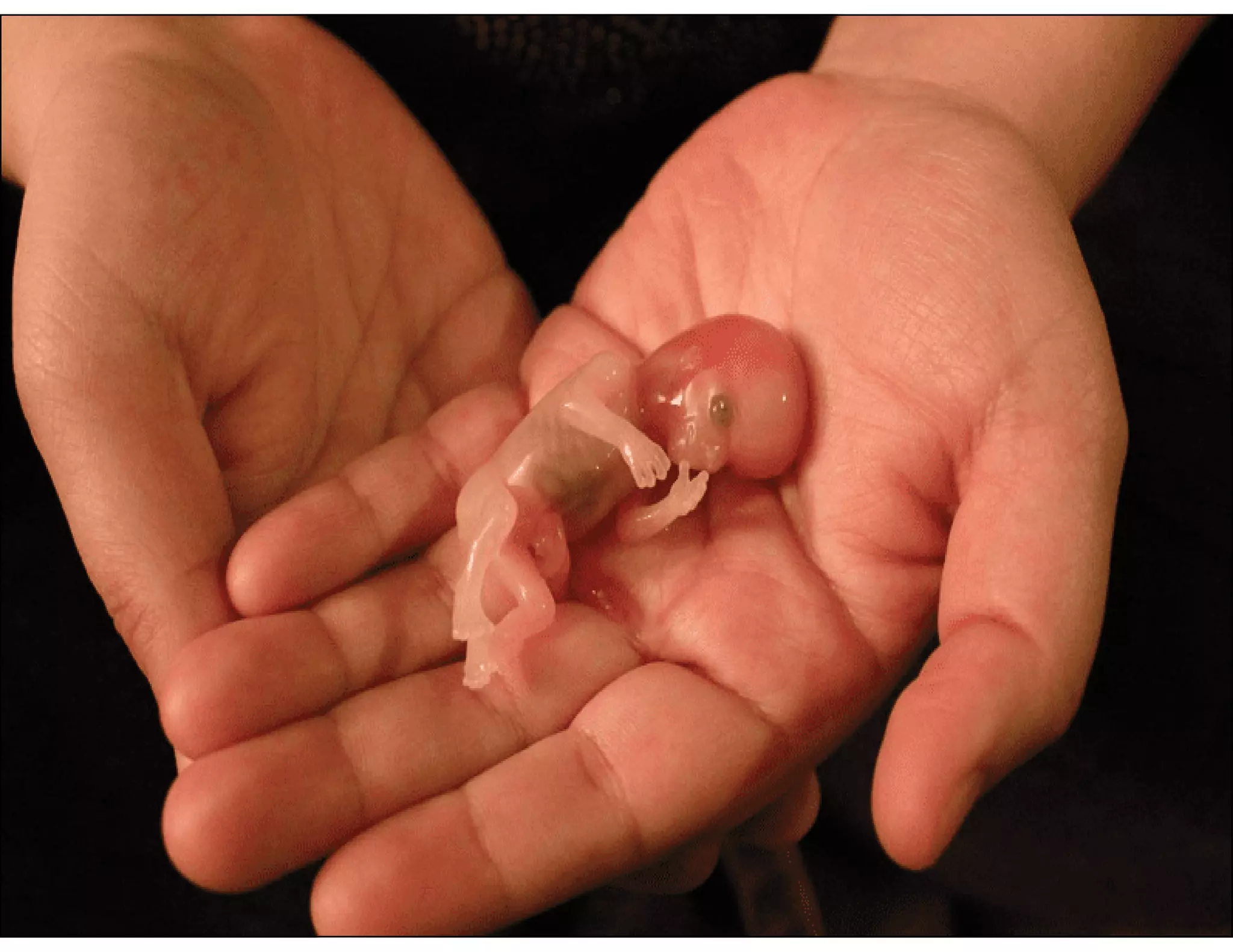 spontaneous Abortion.pdf