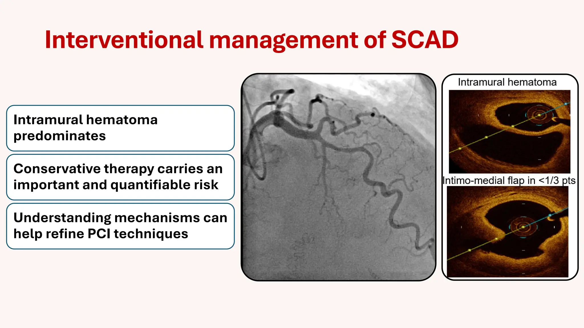 Spontaneous Coronary Artery Dissection (SCAD) | PDF