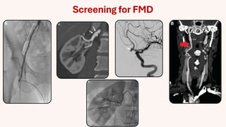 Spontaneous Coronary Artery Dissection (SCAD) | PDF
