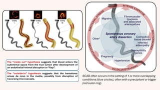 Spontaneous Coronary Artery Dissection (SCAD) | PDF