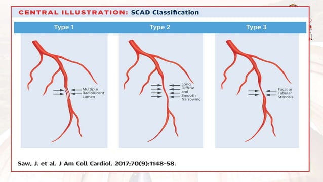 Spontaneous coronary artery dissection in women | PPTX