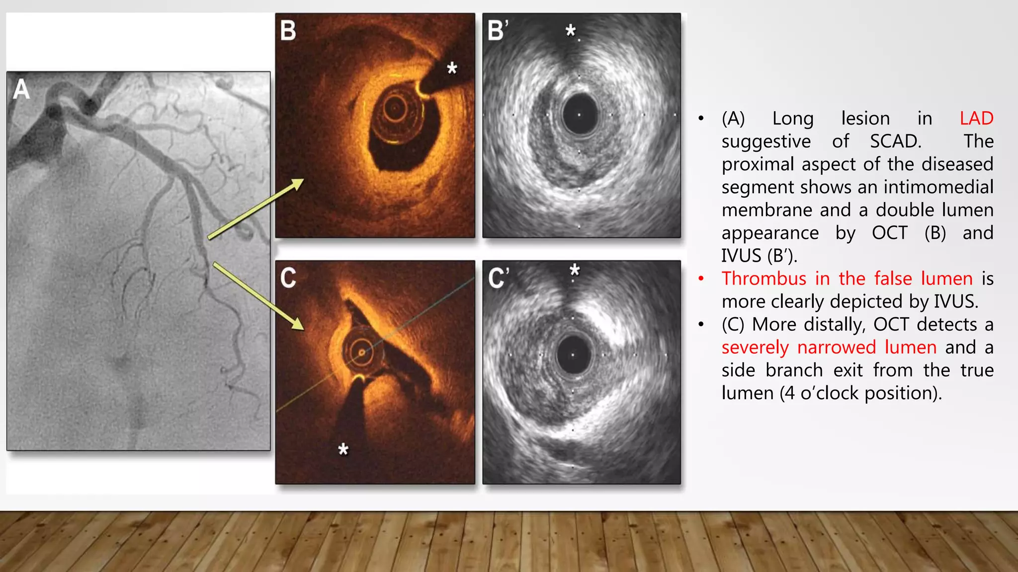 Non-Astherosclerotic Spontaneous Coronary Dissection | PPT