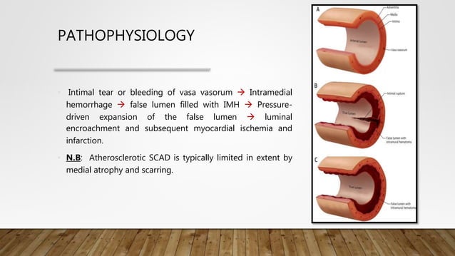 Non-Astherosclerotic Spontaneous Coronary Dissection | PPT