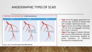 Non-Astherosclerotic Spontaneous Coronary Dissection | PPT