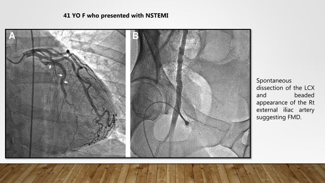 Non-Astherosclerotic Spontaneous Coronary Dissection | PPT