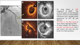 Non-Astherosclerotic Spontaneous Coronary Dissection | PPT