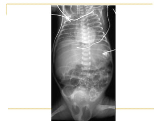 Spontaneous intestinal perforation vs nec | PPT
