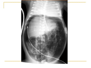Spontaneous intestinal perforation vs nec | PPT