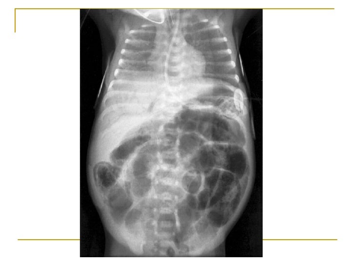 Spontaneous Intestinal Perforation Vs Nec