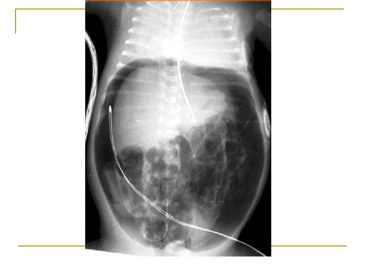 Spontaneous intestinal perforation vs nec