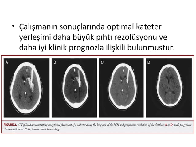 Spontaneous intracerebral and intraventricular hemorrhage | PPT