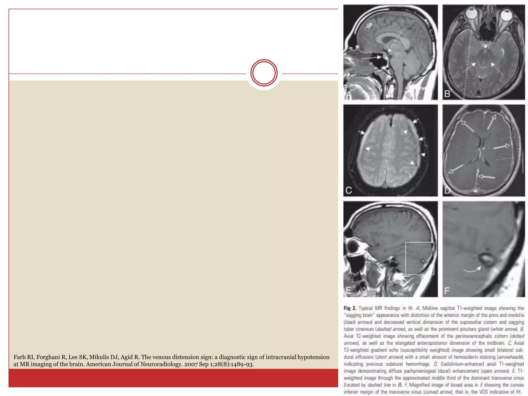 Spontaneous Intracranial Hypotension.pptx