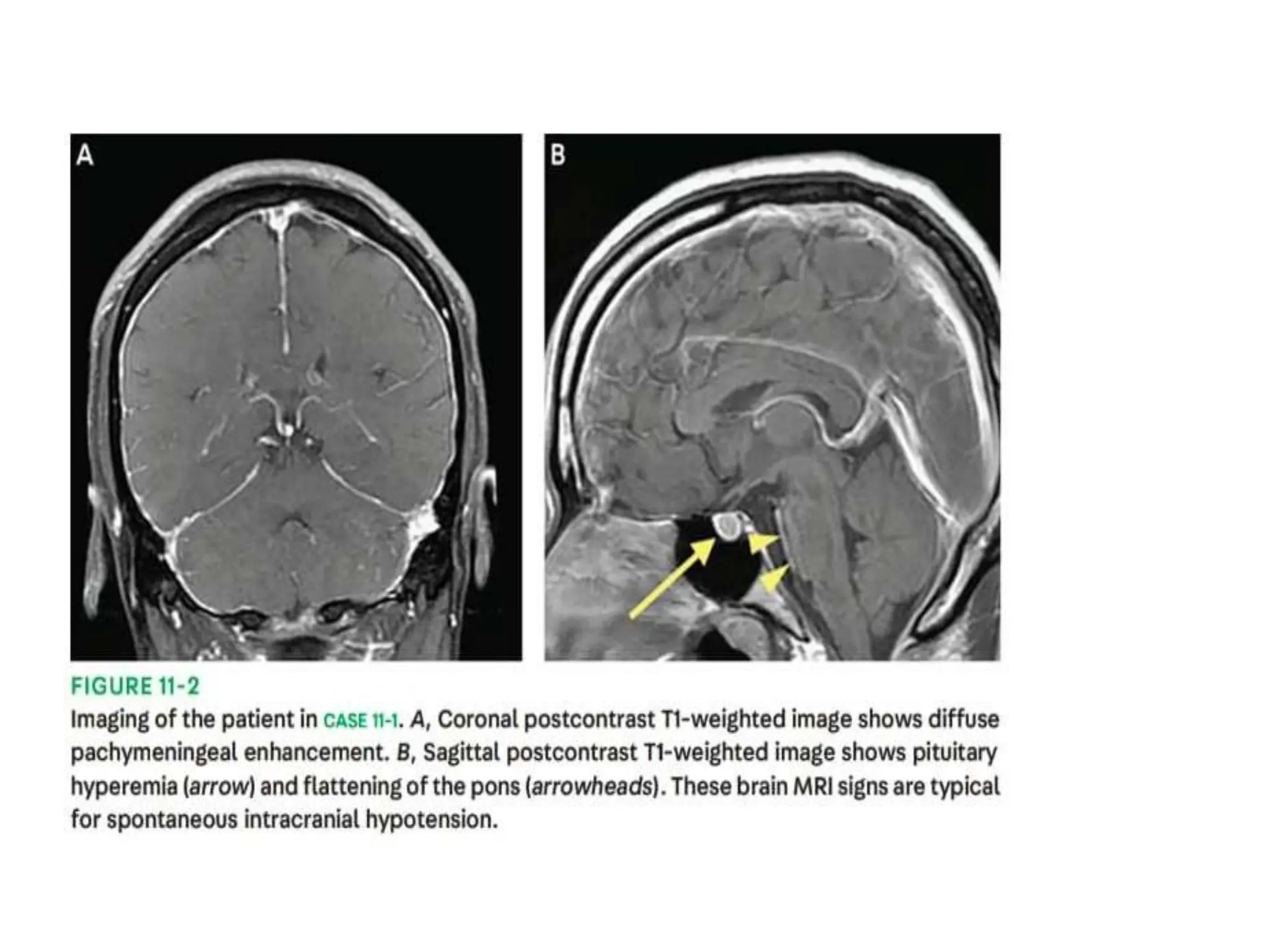 spontaneous intracranial hypotension.pptx