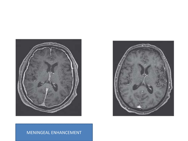 spontaneous intracranial hypotension.pptx