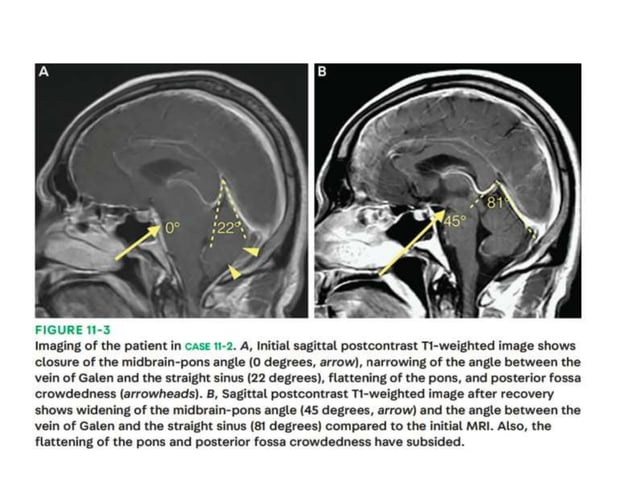 spontaneous intracranial hypotension.pptx