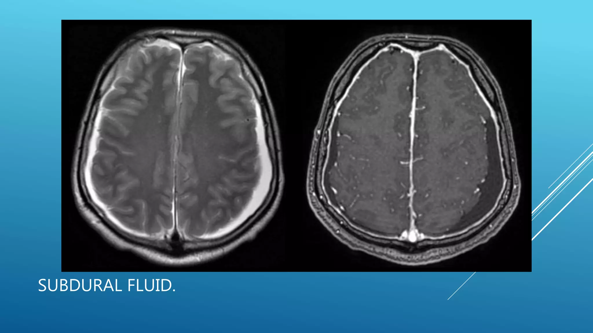 Spontaneous intracranial hypotension (sih) | PPTX