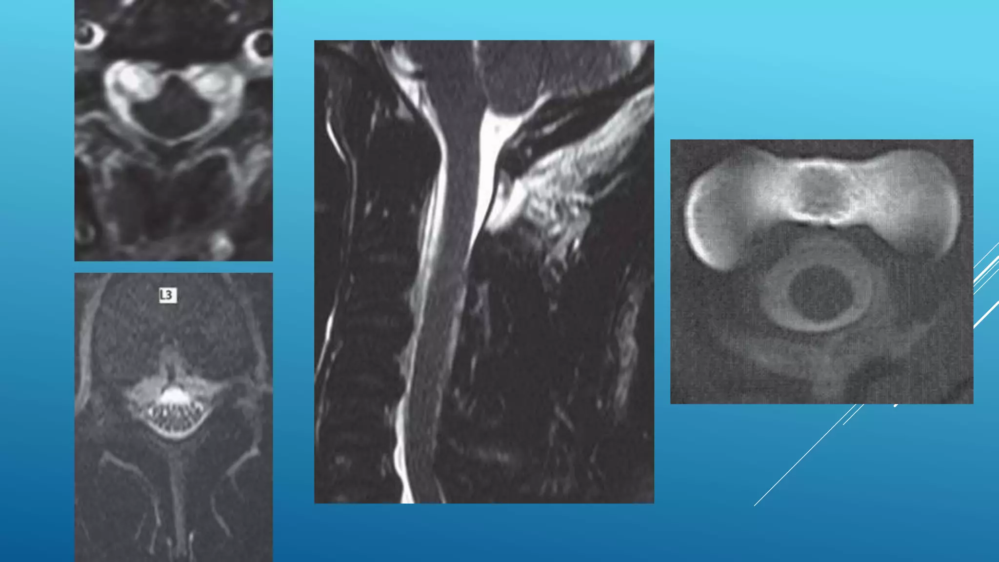 Spontaneous intracranial hypotension (sih) | PPTX