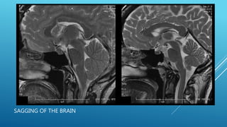 Spontaneous intracranial hypotension (sih) | PPTX | Brain and Nervous ...